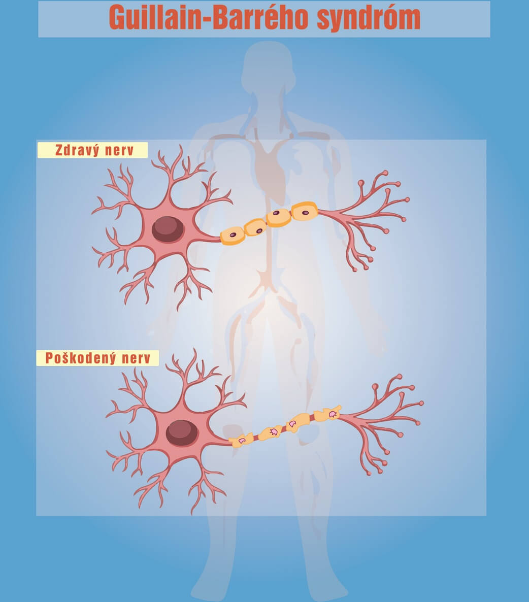 Guillain-Barrého syndróm: Príznaky, príčiny a liečba