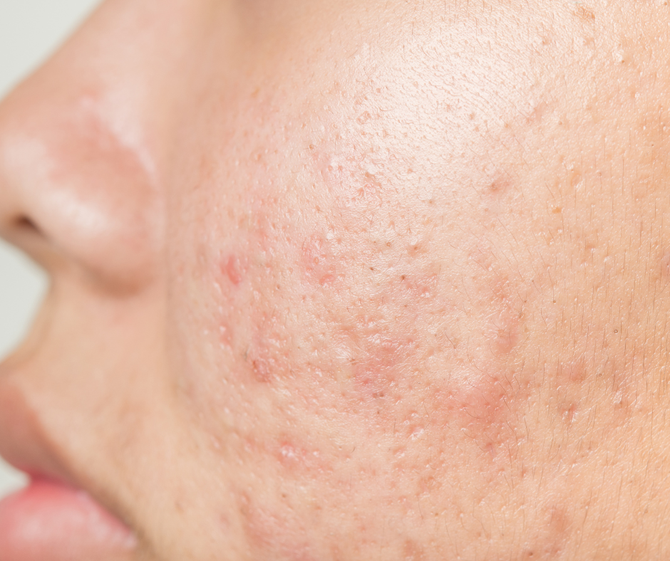 Jizevnaté akné? Jak se ho zbavit? - Kosmetika Kesem