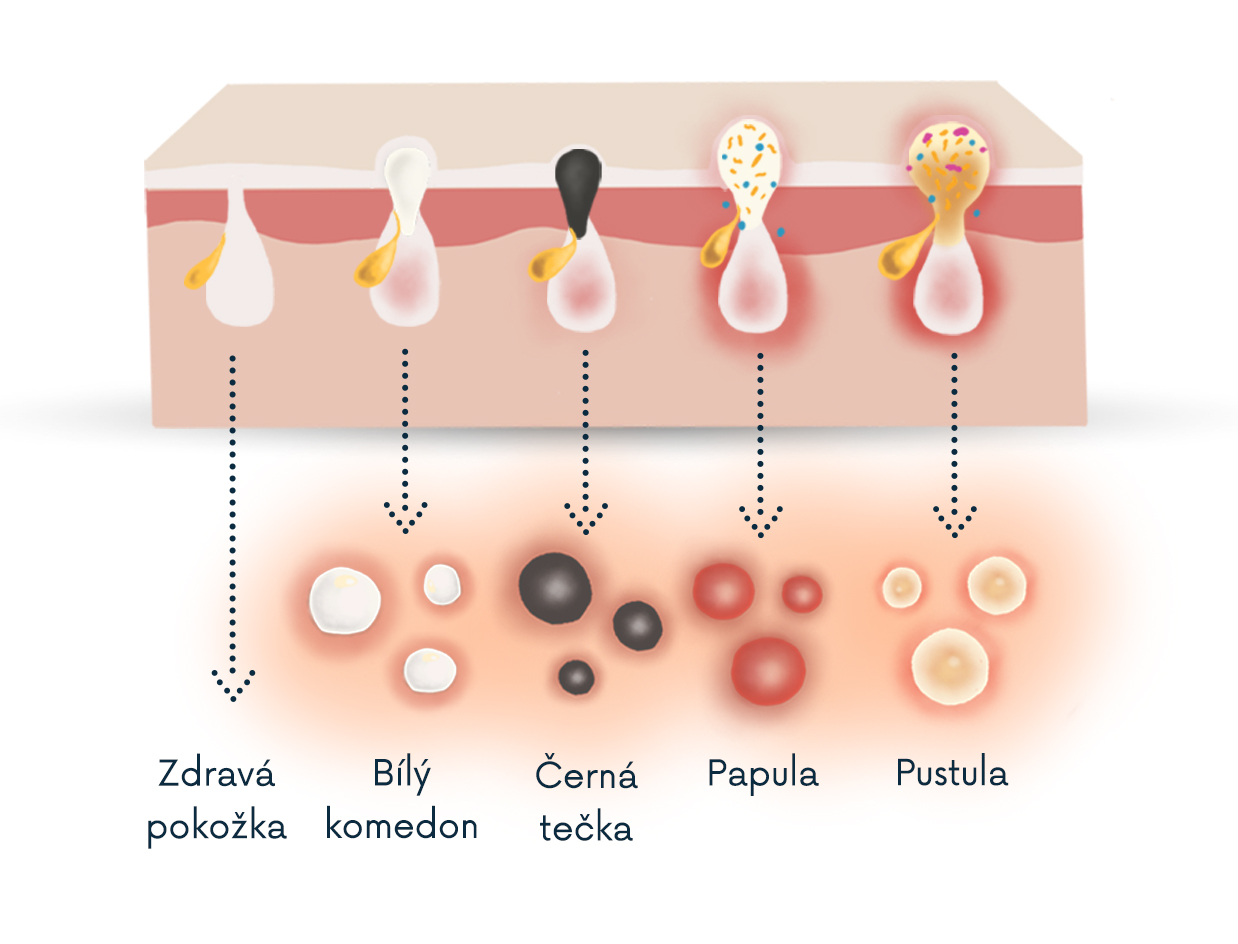 Druhy akné | LOBEY Laboratories s.r.o.