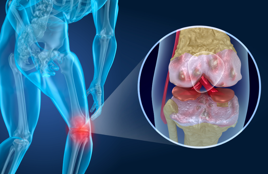 Nejčastější příčiny bolesti kolene - MedikoBio