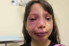 Co je Sturge-Weberův syndrom a jak ho léčit