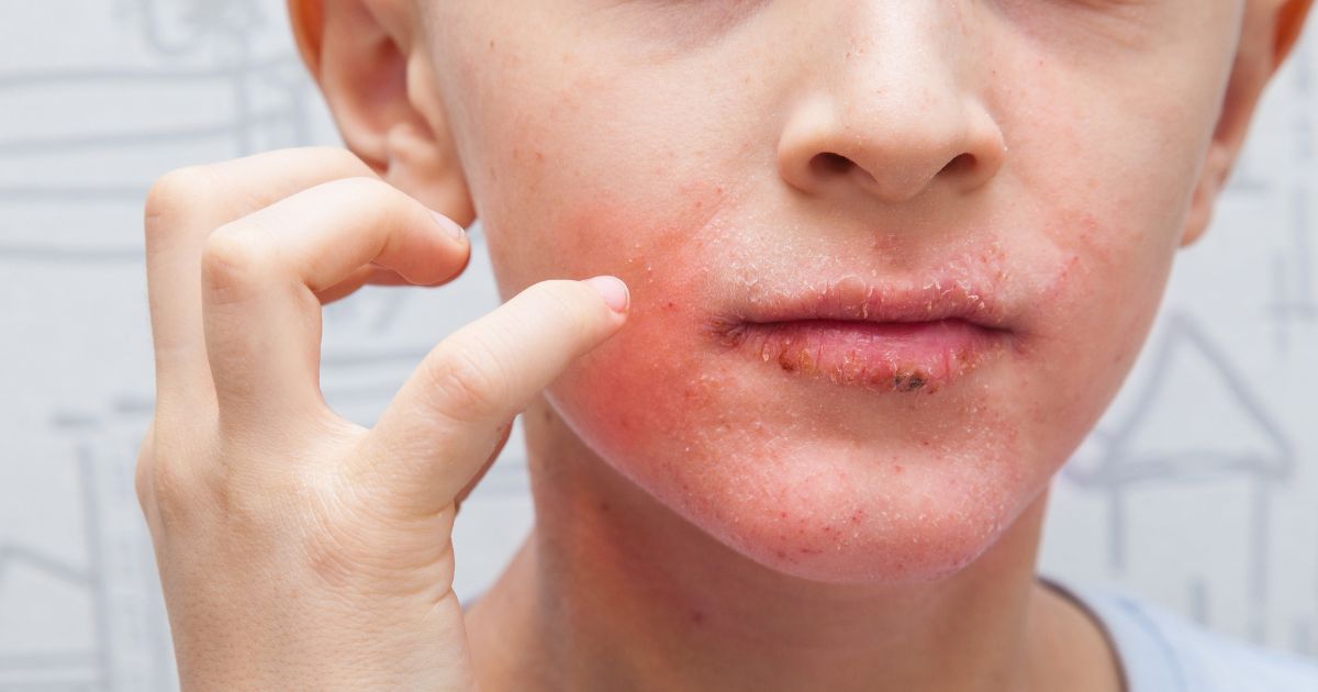 Atopický ekzém u dětí: Čím mazat a jaké přípravky volit