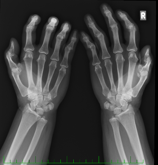 Rozdiel medzi osteoartrózou a reumatoidnou artritídou - Rehabilitačné ...