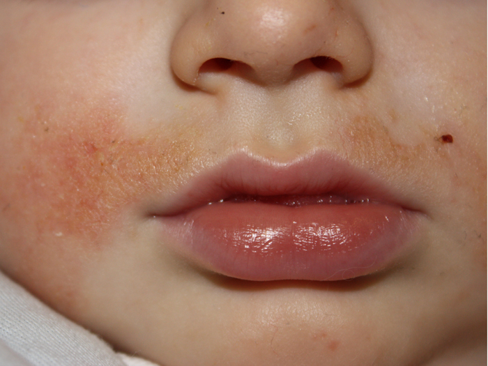 Atopický ekzém - léčba? Nejdříve je třeba odstranit příčinu!