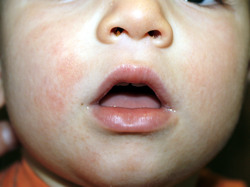 Atopický ekzém a jeho léčba? Jak vyléčit atopický ekzém?