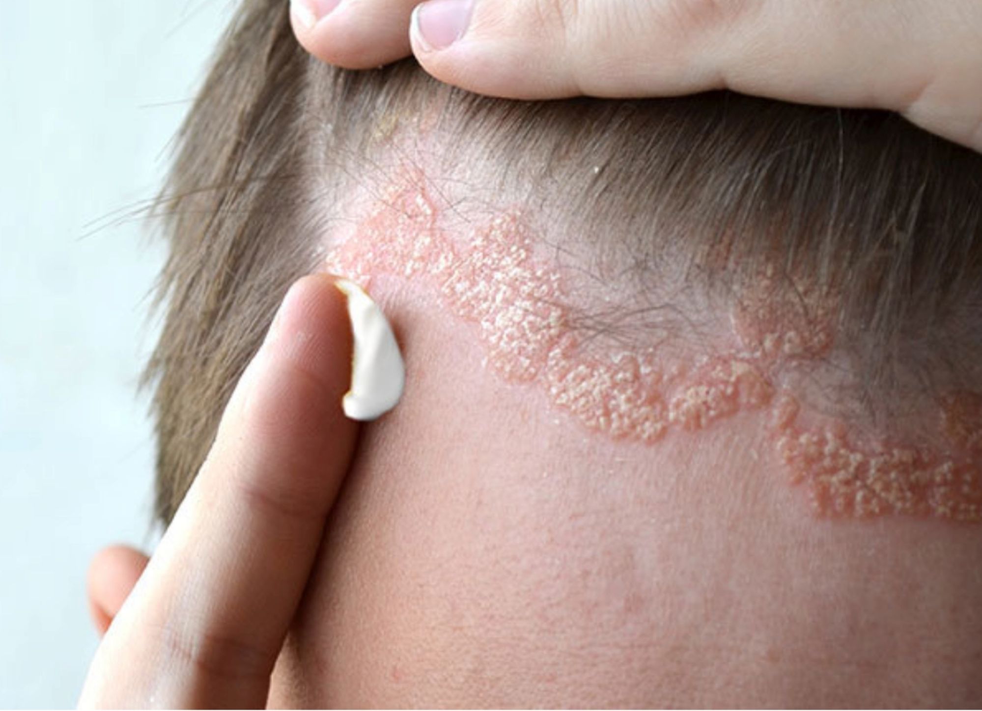 Seborea se může objevit u dětí i dospělých. Zjistěte, jak ji zmírnit ...