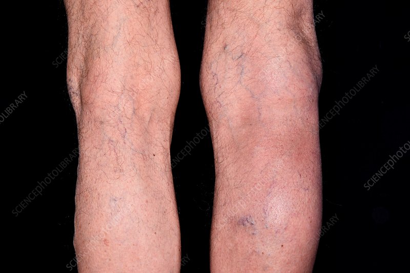 Bakerova cysta: Ako spoznať opuch za kolenom a zbaviť sa bolesti?