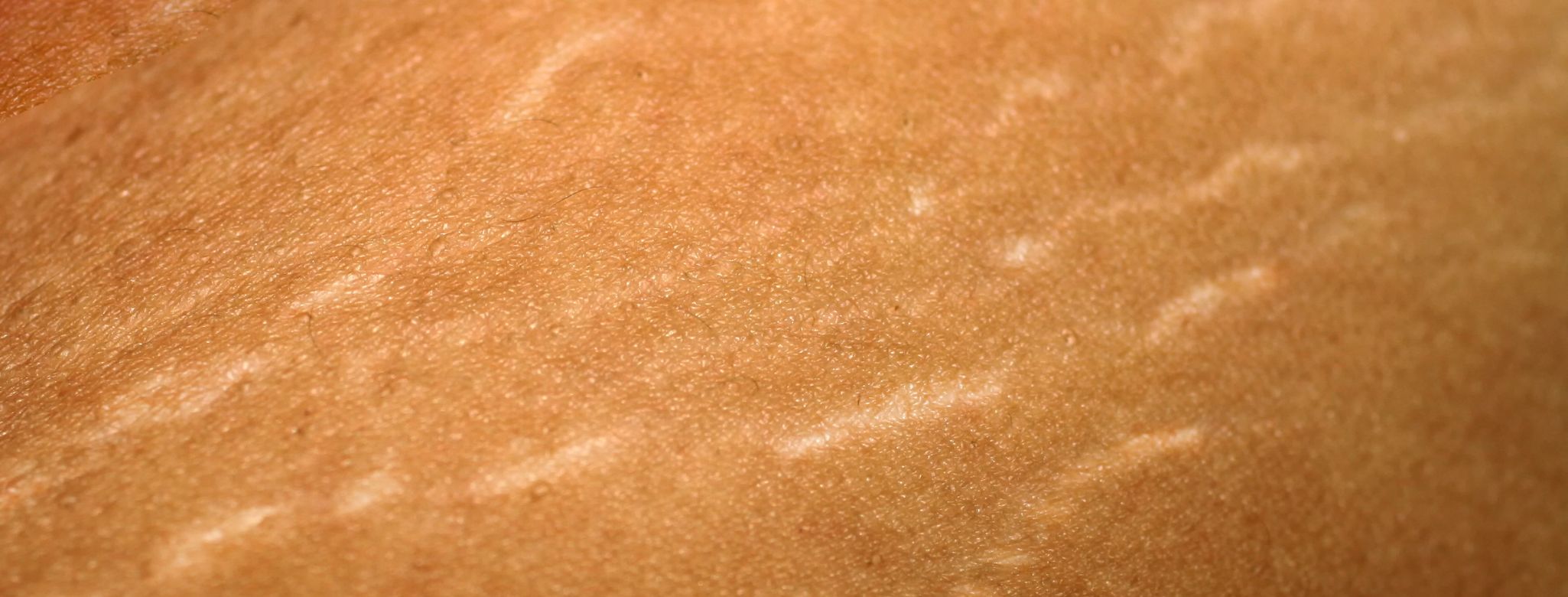 Strie na stehnech |FARM.INC