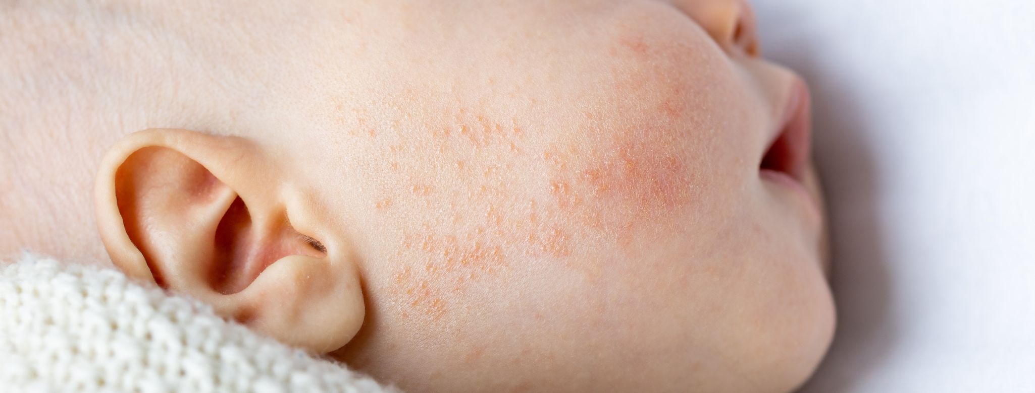 Jak poznat atopický ekzém u kojence? |FARM.INC