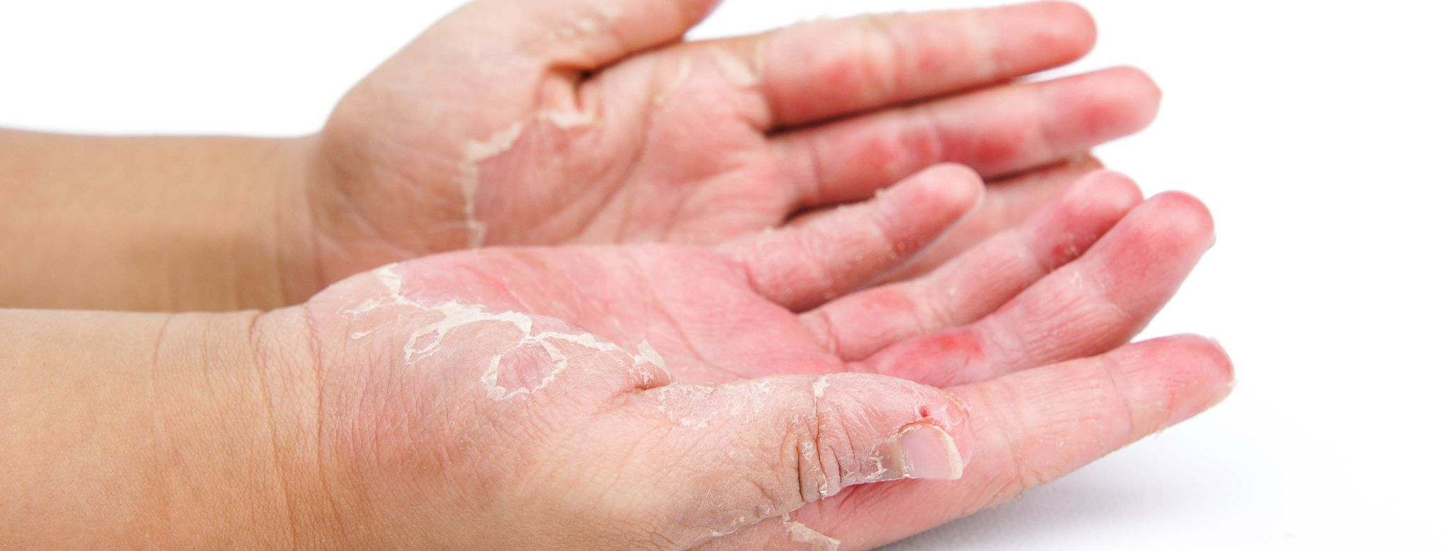 Suché a popraskané ruce do krve: Zkuste přírodní léčbu |FARM.INC